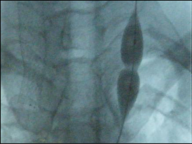 Interventional Radiology | Hudson Valley Radiologists, P.C.